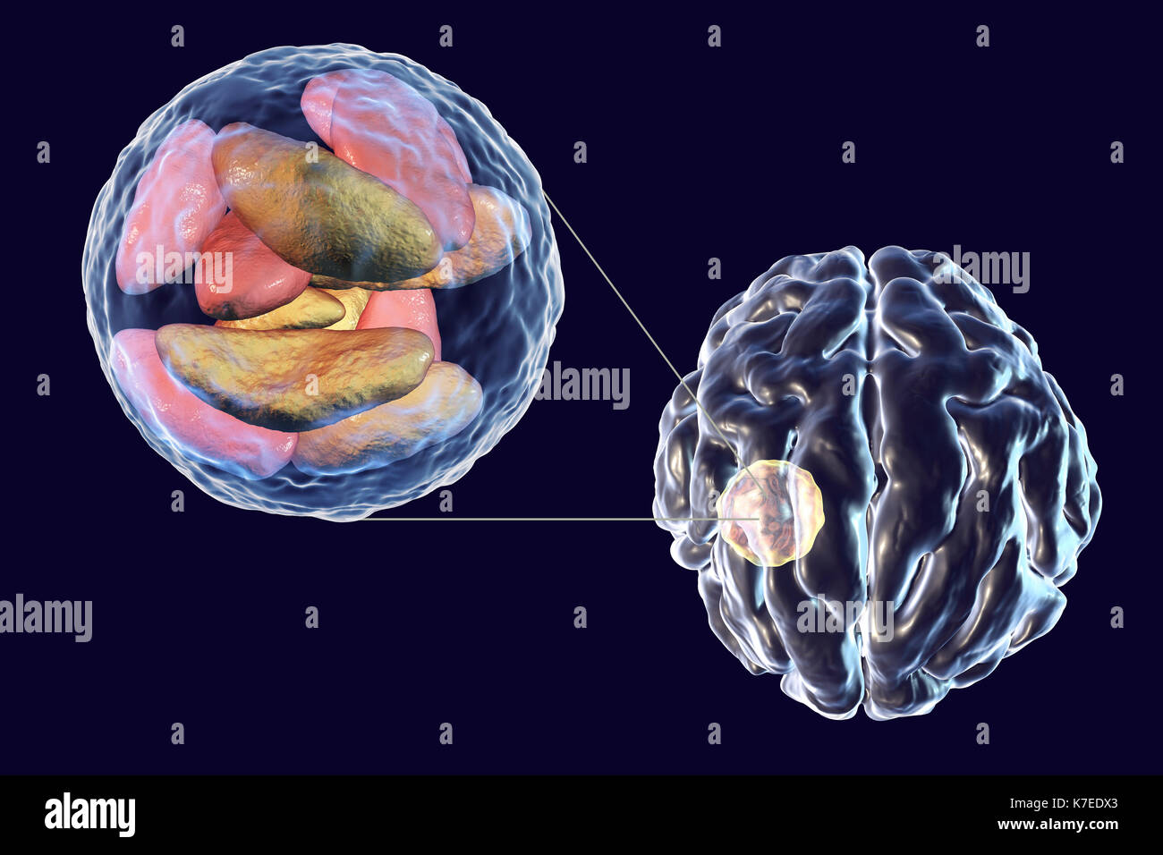 Neurotoxoplasmosis, computer illustration. Brain abscess caused by ...