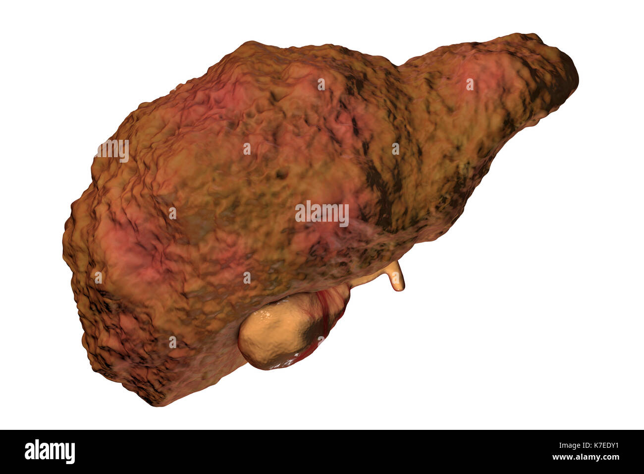 Liver disease skin High Resolution Stock Photography and Images - Alamy