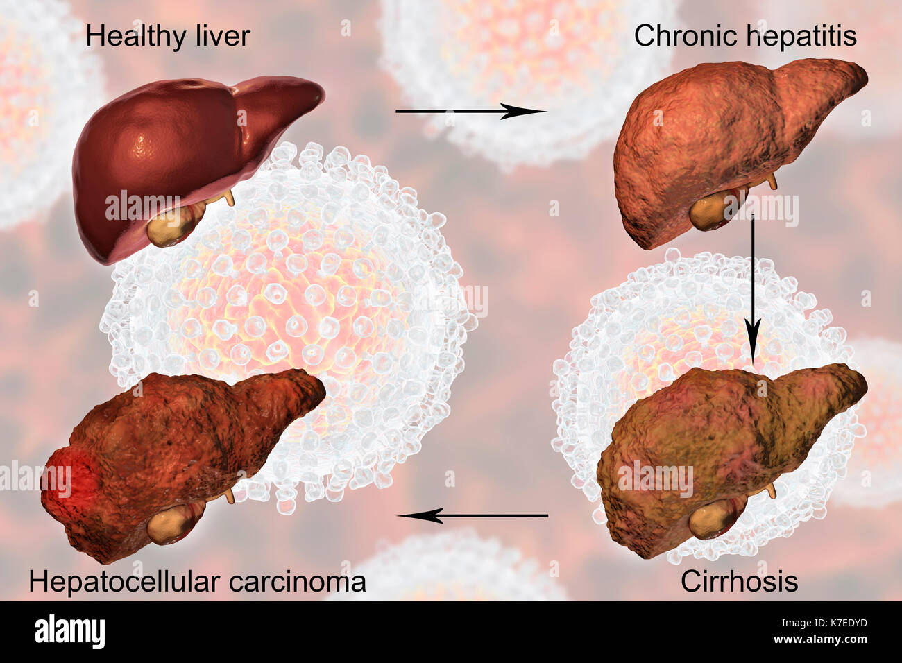 Liver Disease Stages