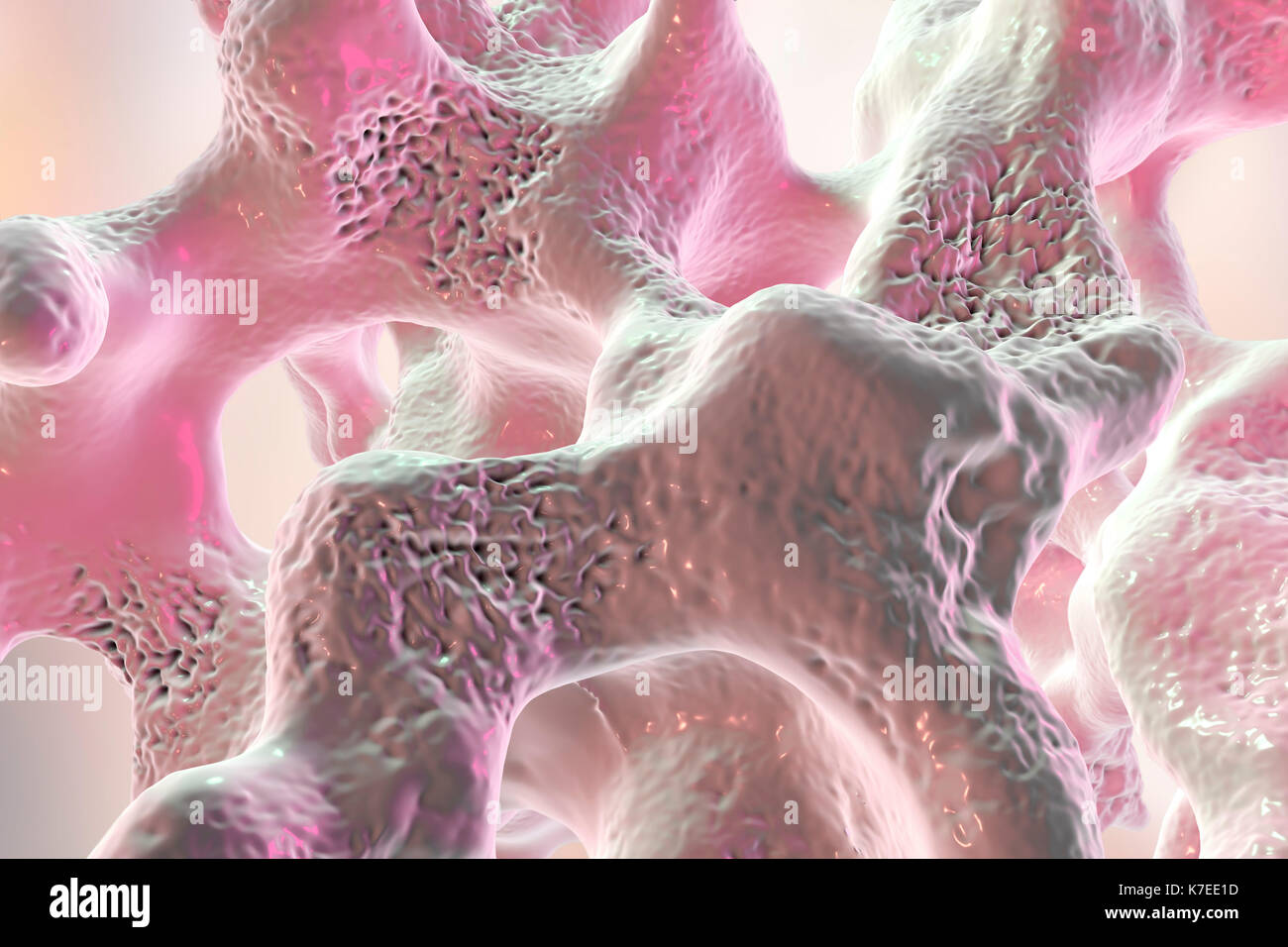 Illustration of bone structure affected by osteoporosis. Thinning of ...