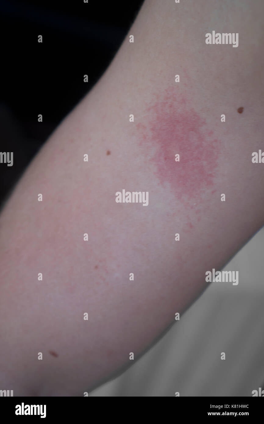 Insect bite hi-res stock photography and images - Alamy