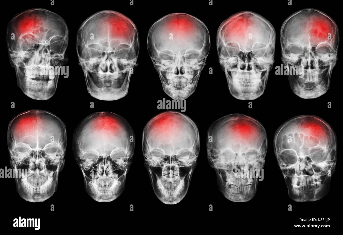 X Ray Head Injury
