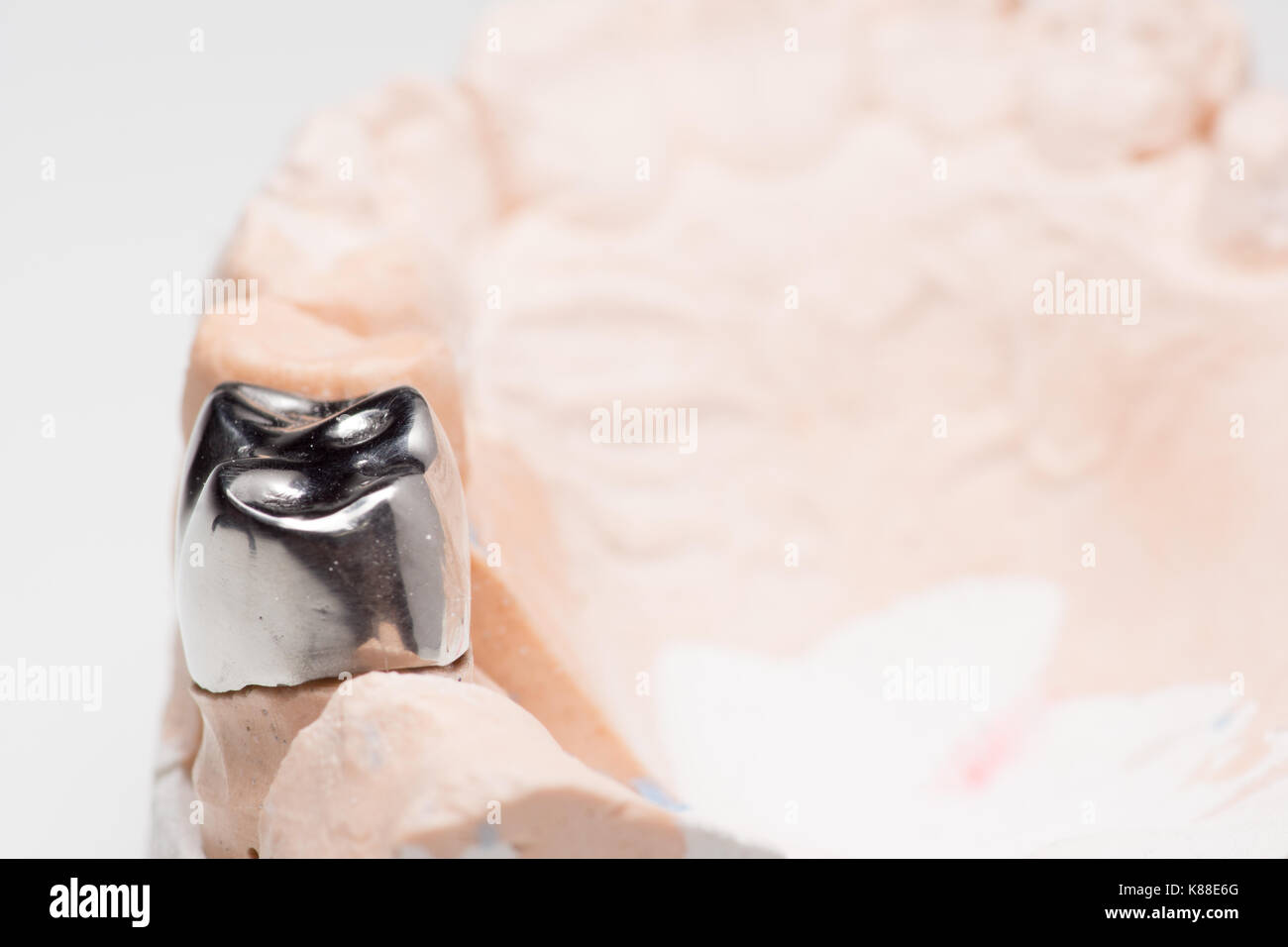 Steel artificial dental crown for dentition restoration Stock Photo - Alamy