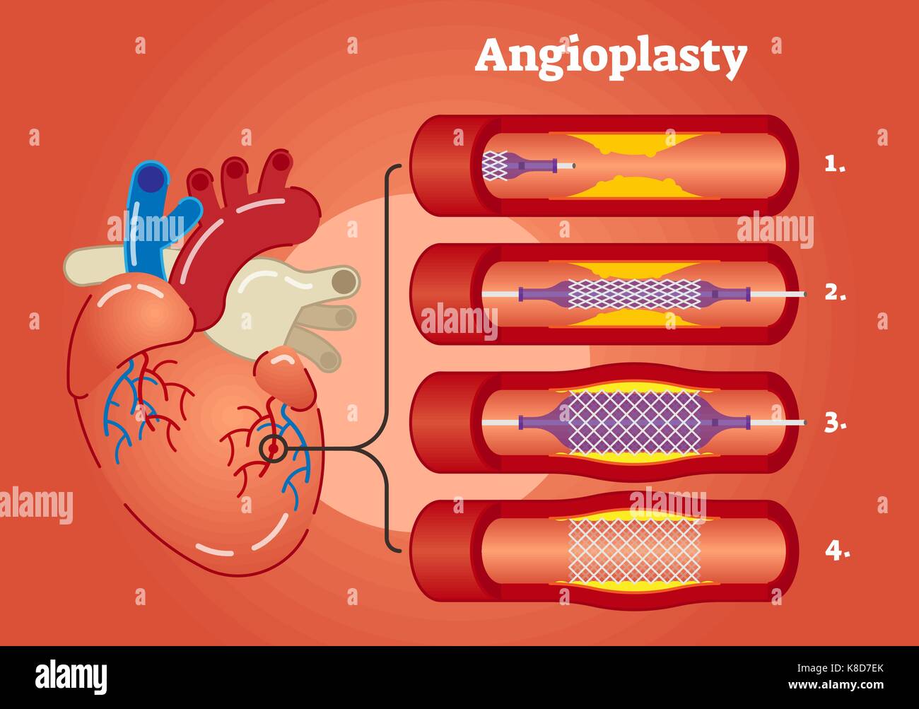 Medical concept coronary angioplasty stent hi-res stock photography and ...