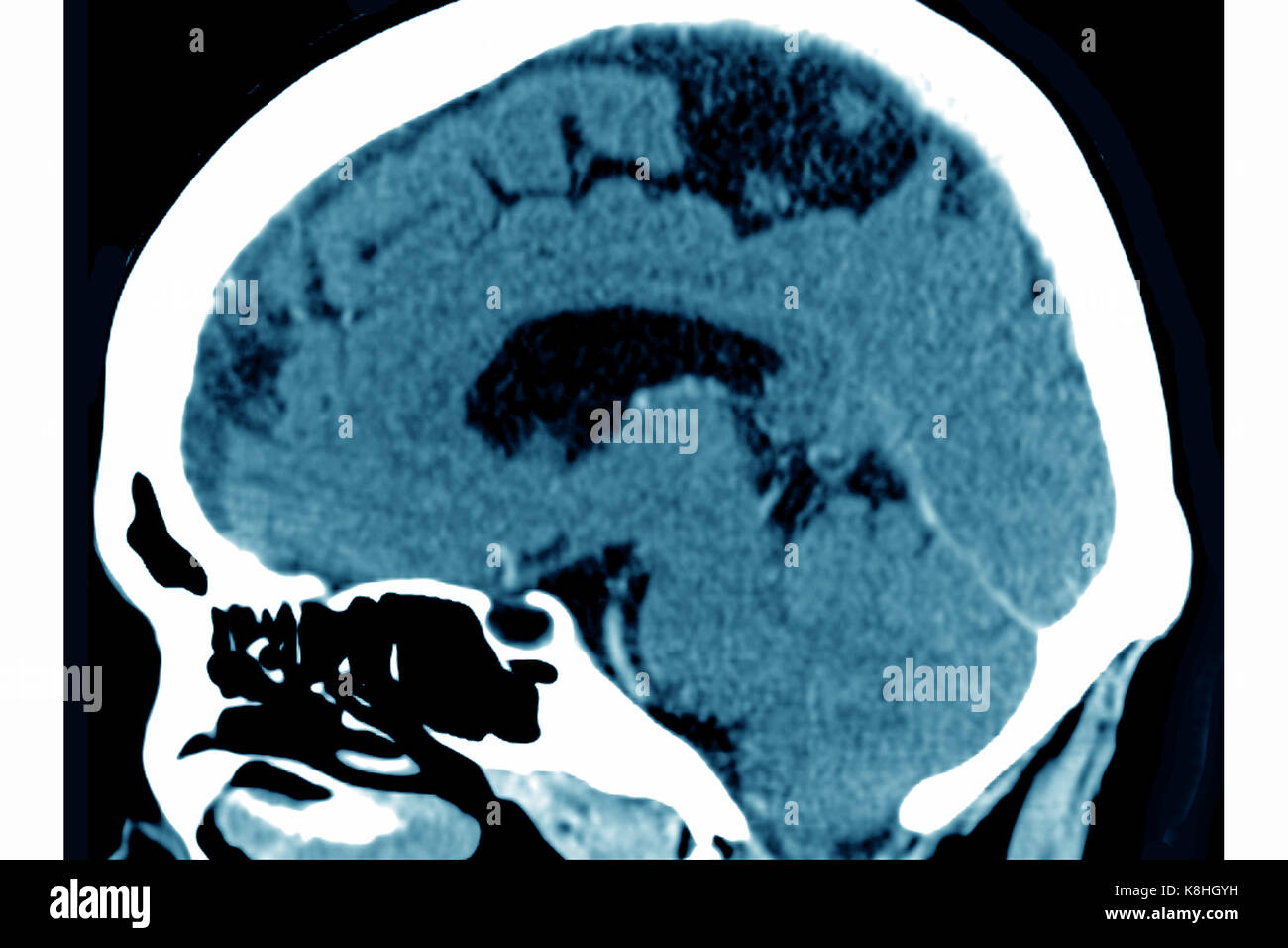 Cerebral atrophy ct scan hi-res stock photography and images - Alamy
