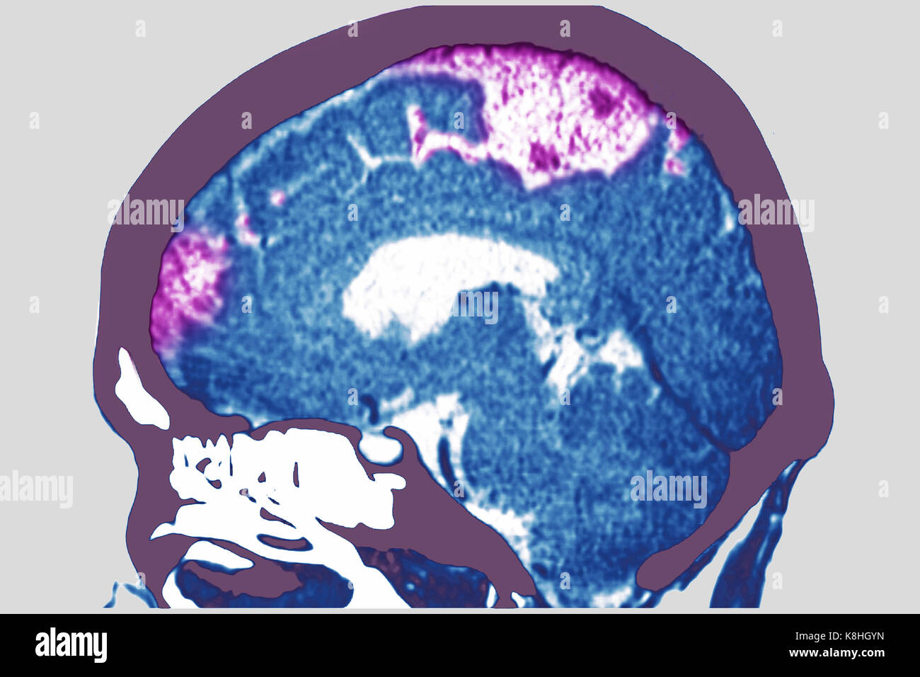 Cerebral Atrophy Ct Scan High Resolution Stock Photography and Images ...