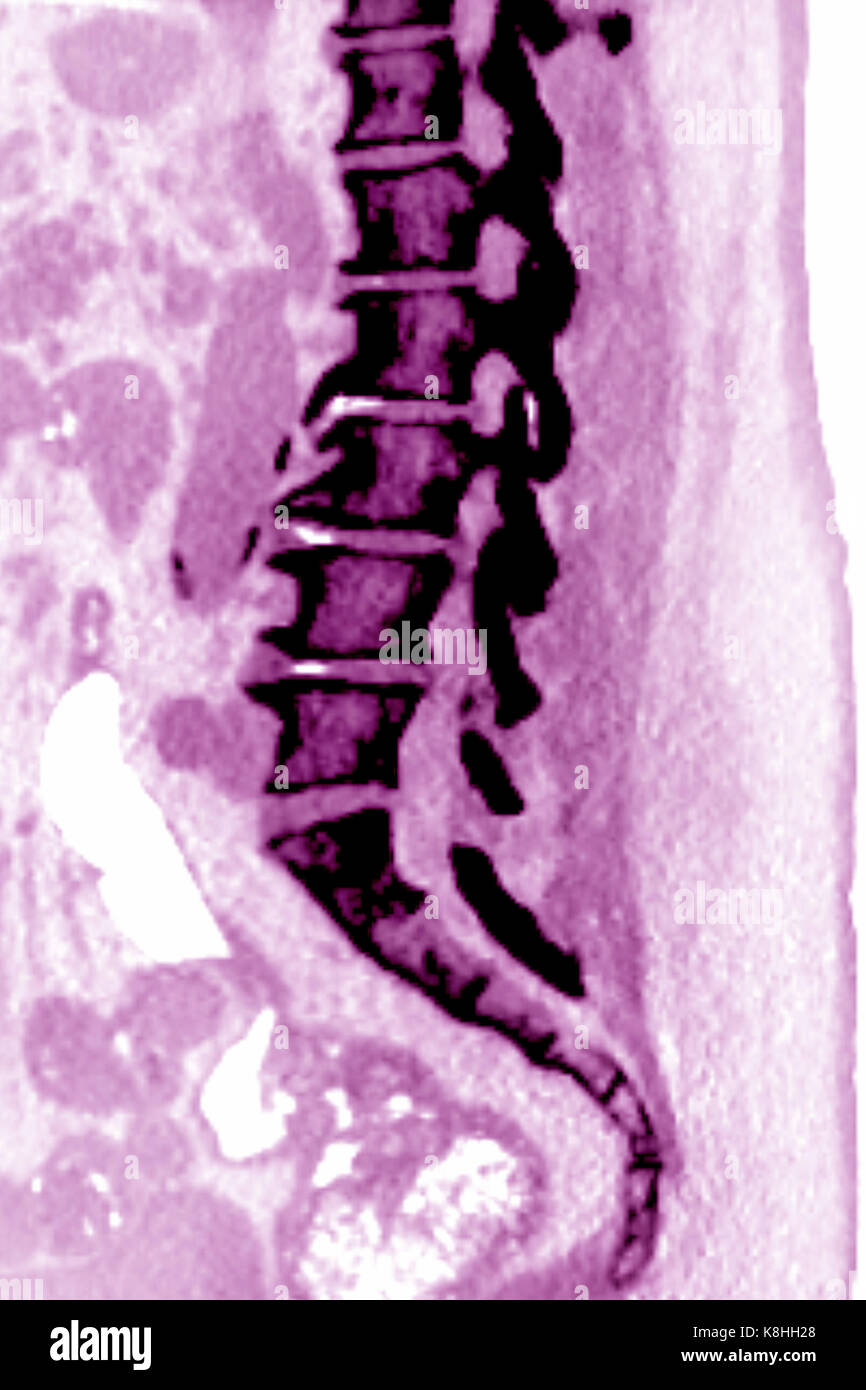 Bone Scan Stock Photos & Bone Scan Stock Images - Alamy