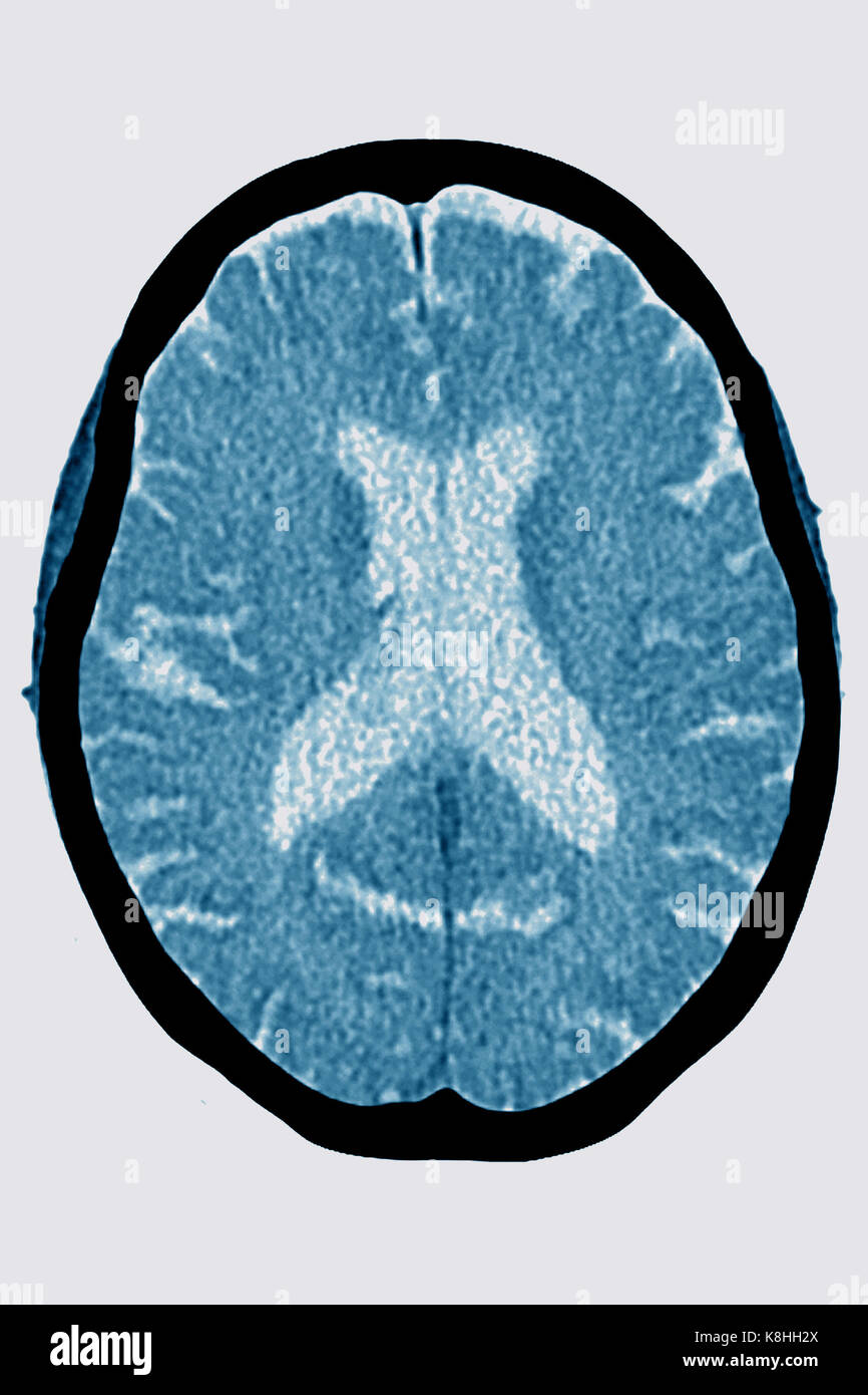 CEREBRAL ATROPHY, CT SCAN Stock Photo - Alamy