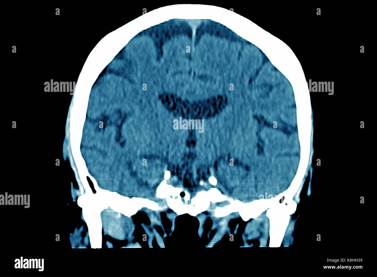 Cerebral atrophy ct scan hi-res stock photography and images - Alamy