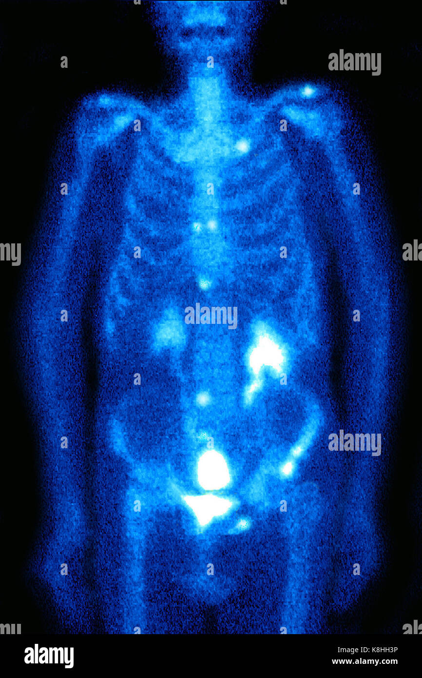 Scintiscanning hi-res stock photography and images - Alamy