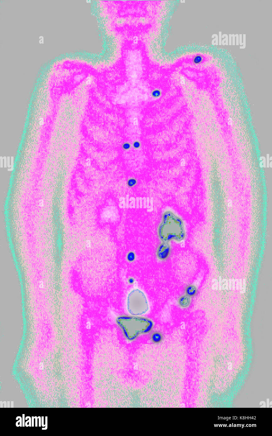 Carcinoma and metastasis hi-res stock photography and images - Alamy