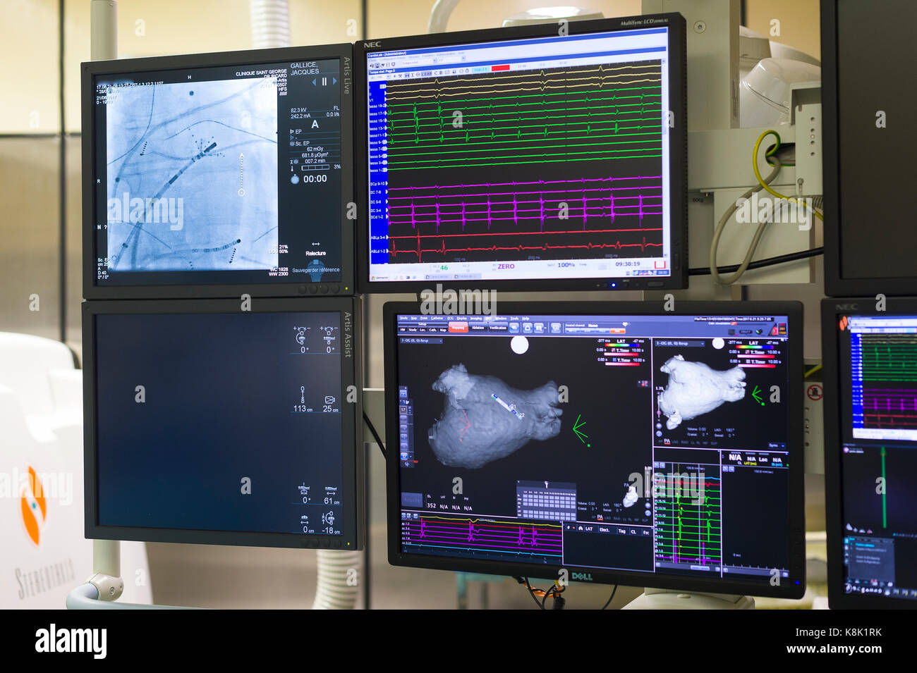 Radiofrequency catheter ablation, heart hi-res stock photography and ...