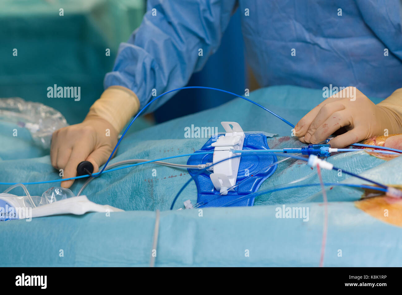 Radiofrequency Ablation High Resolution Stock Photography and Images ...