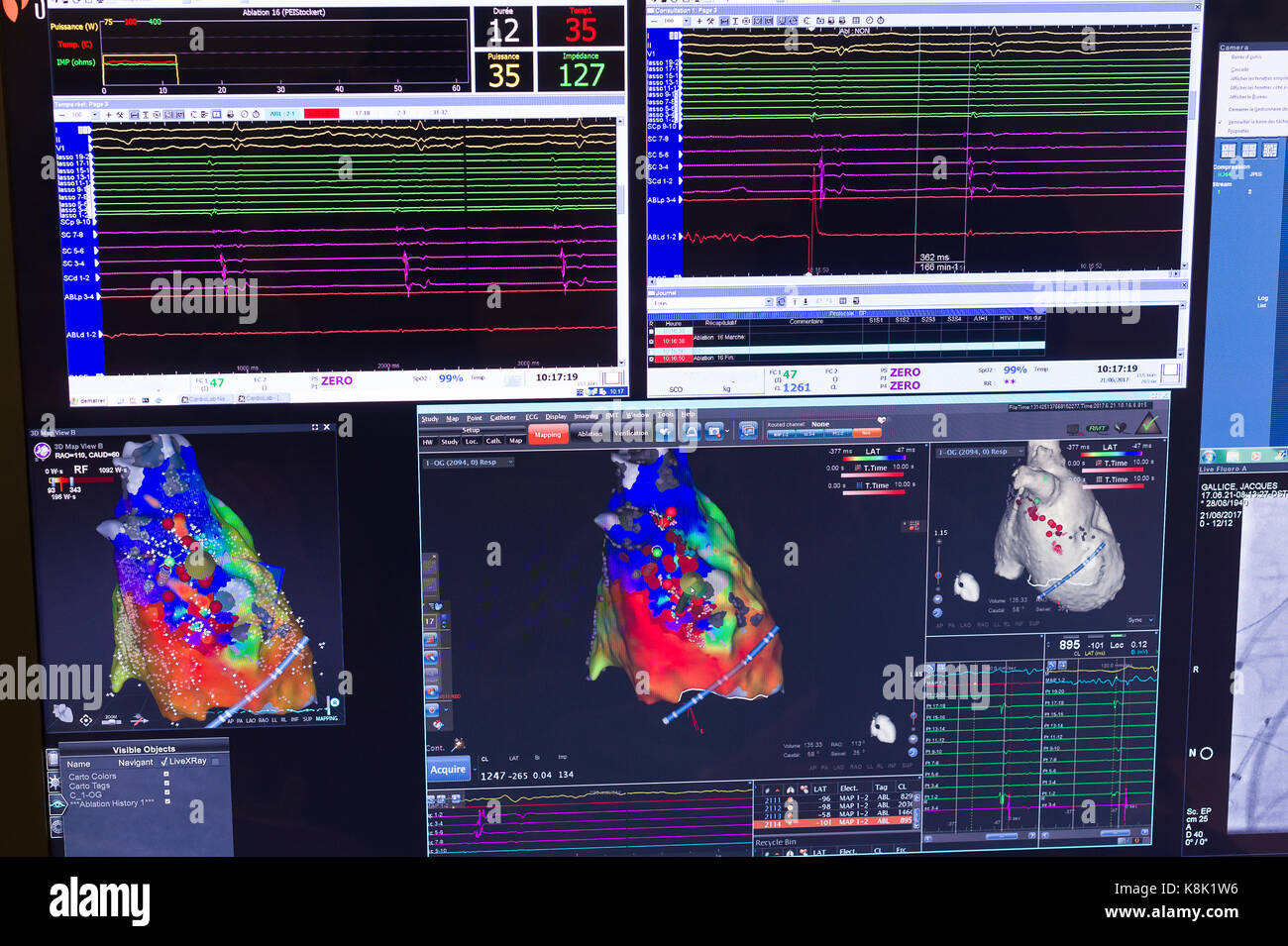 Cardiac ablation hi-res stock photography and images - Alamy