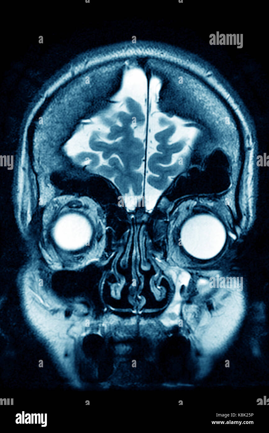 Mri of cerebral atrophy hi-res stock photography and images - Alamy