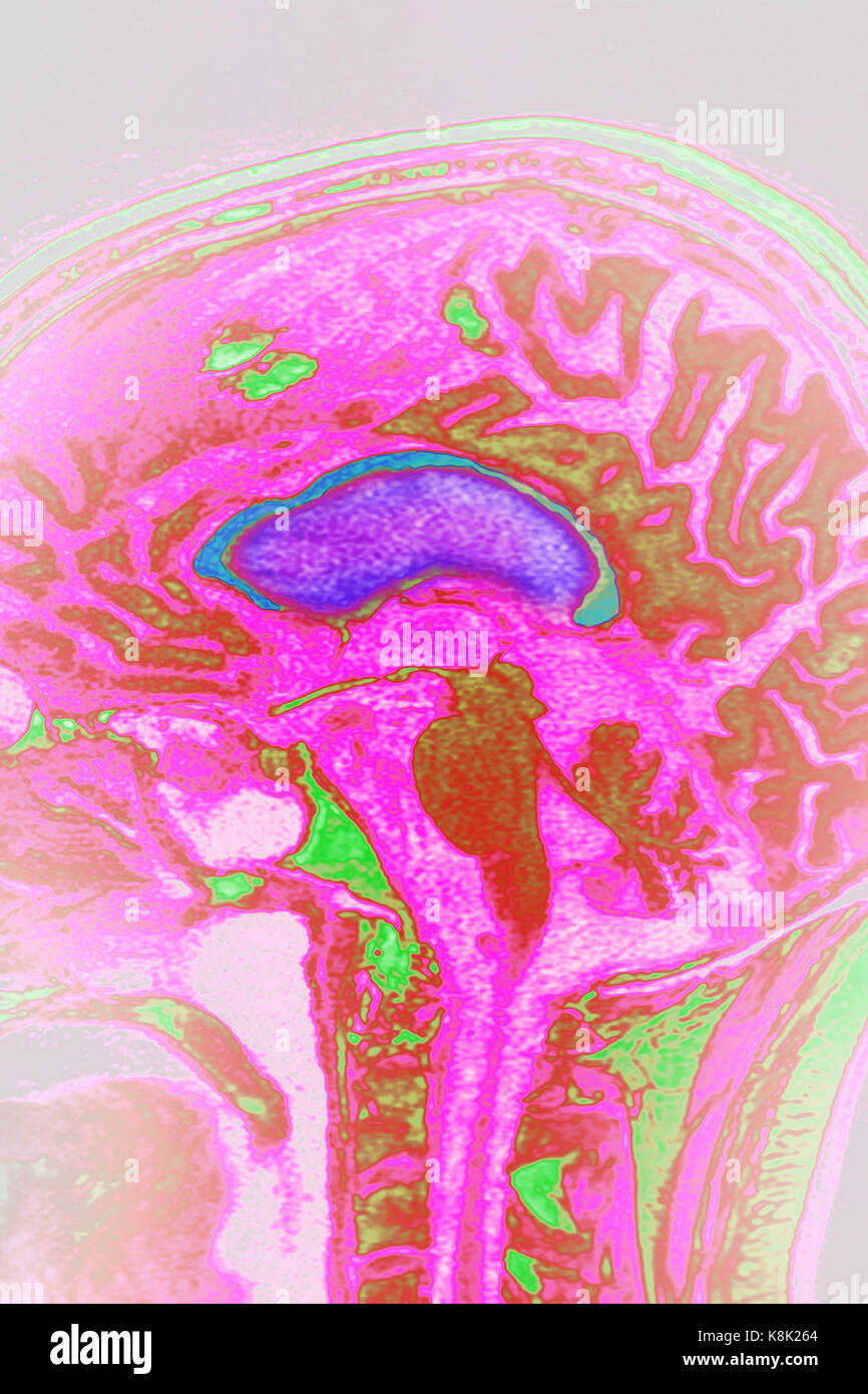 Mri of cerebral atrophy hi-res stock photography and images - Alamy
