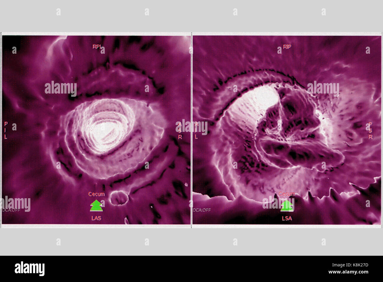 COLON CANCER CT SCAN Stock Photo - Alamy