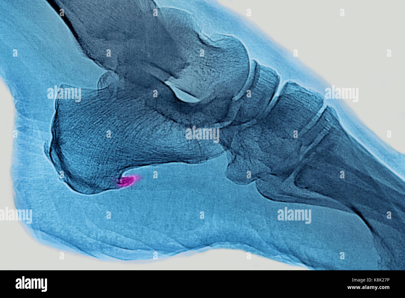 Enthesitis hi-res stock photography and images - Alamy