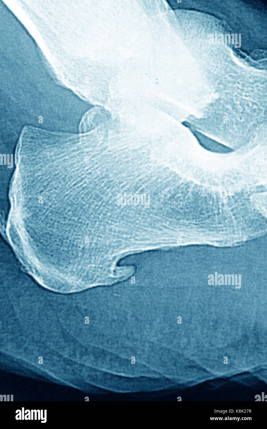 X ray bones of the lower limbs hi-res stock photography and images - Alamy