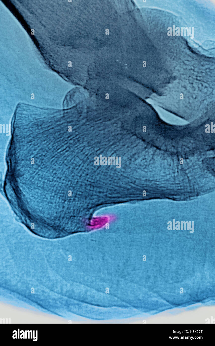 Enthesitis hi-res stock photography and images - Alamy