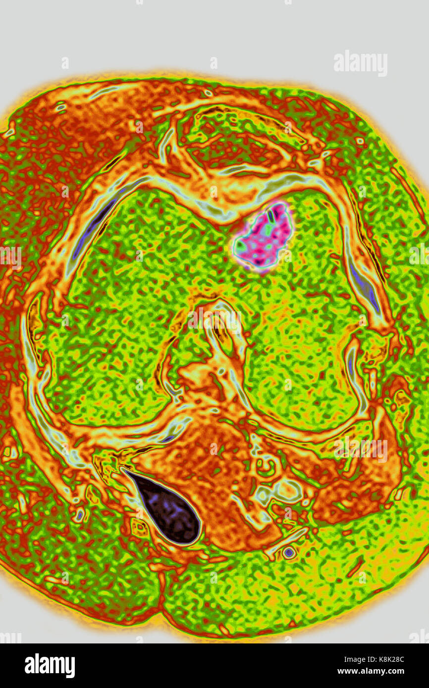 OSSEOUS EDEMA MRI Stock Photo - Alamy