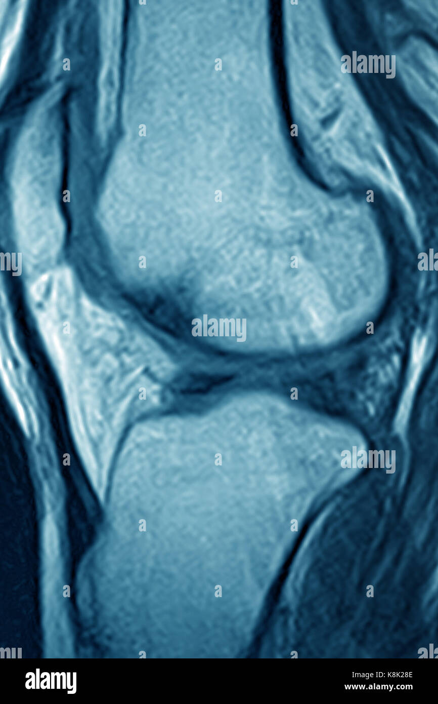 Osseous edema mri hi-res stock photography and images - Alamy