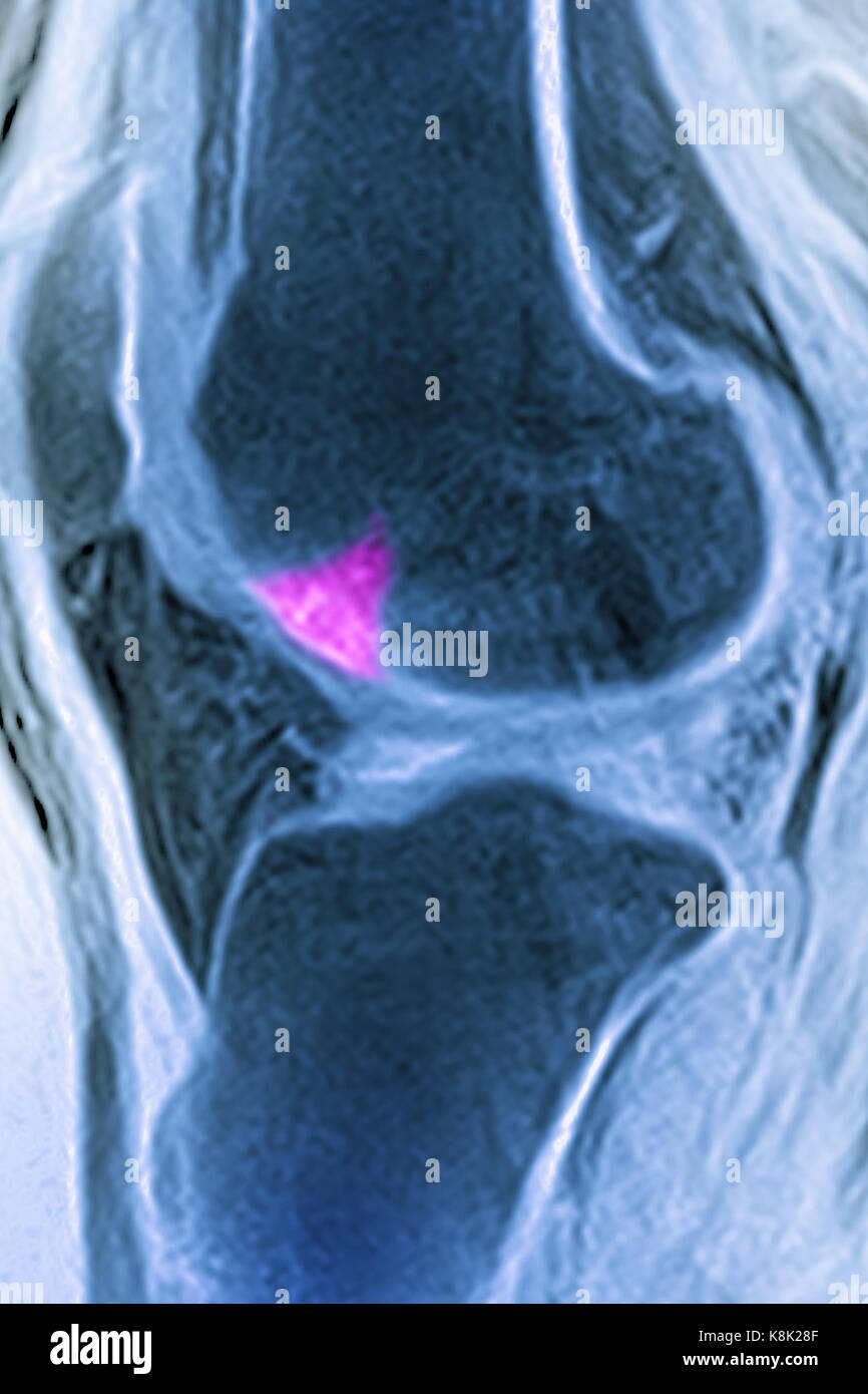 OSSEOUS EDEMA MRI Stock Photo - Alamy