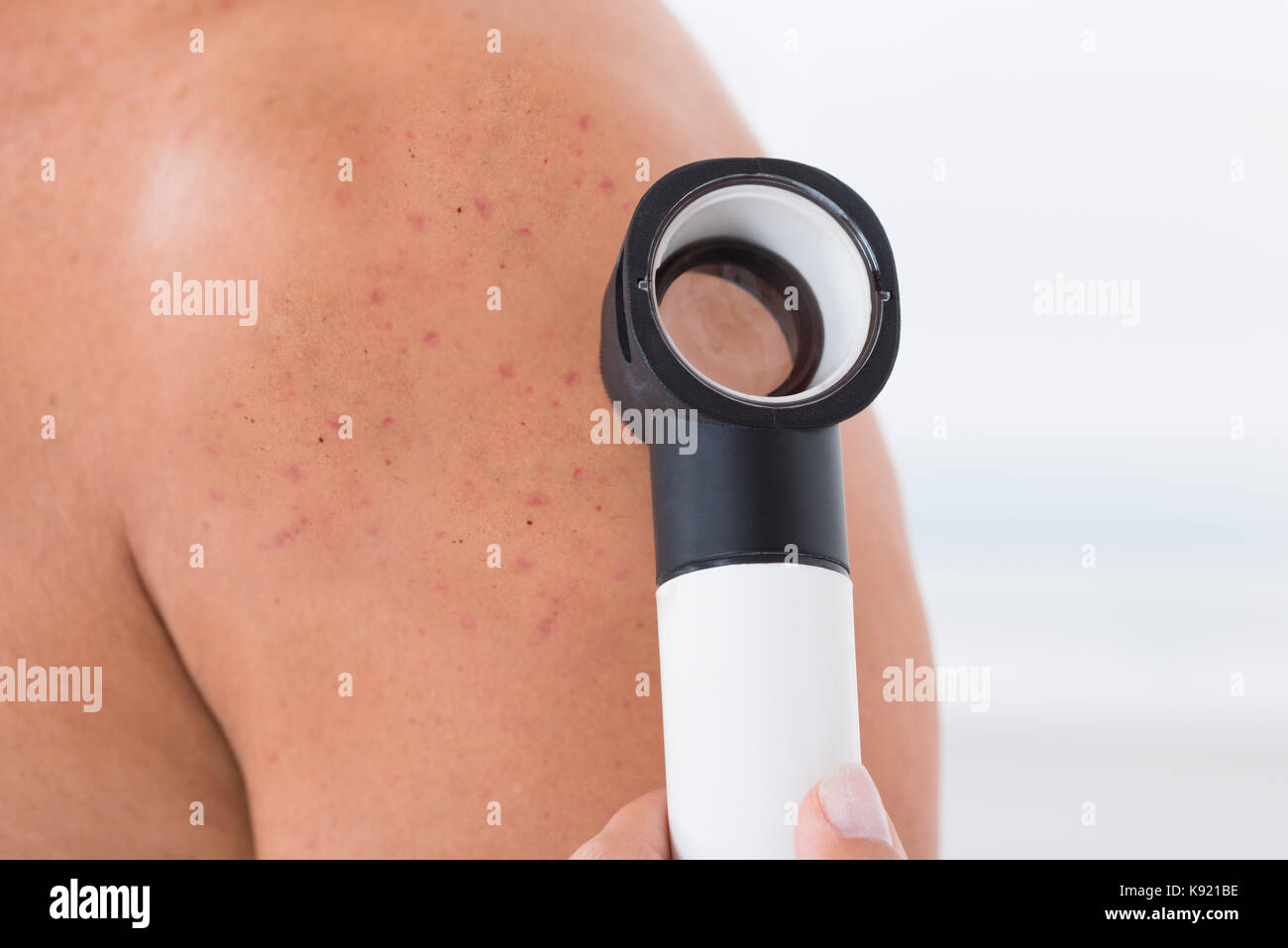 Close-up Of Person Hands Examining Acne Skin Of Man With Dermatoscope ...
