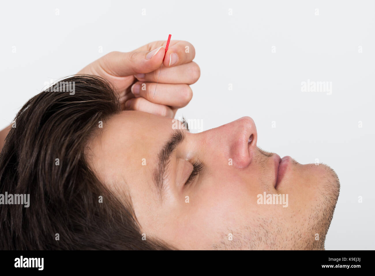 Close-up Of Young Man Receiving Acupuncture Treatment Stock Photo - Alamy