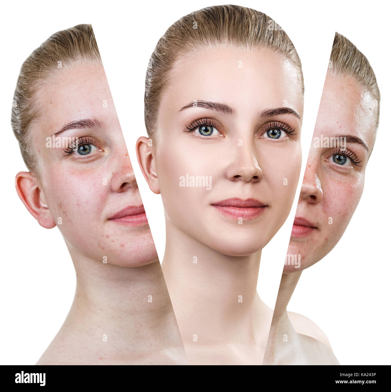 Woman with problem skin Stock Photo - Alamy