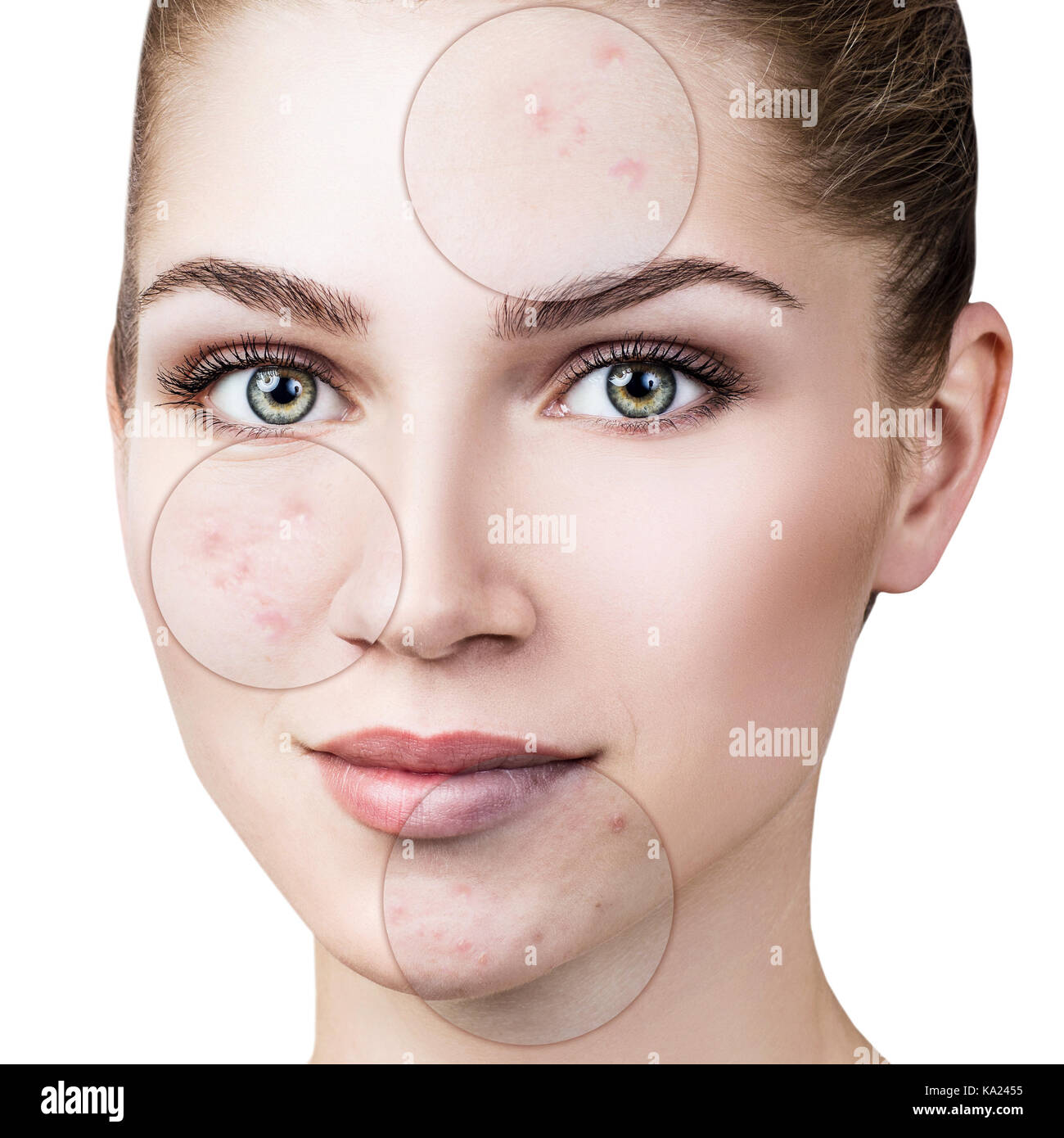 Circles shows problem skin of young woman Stock Photo - Alamy
