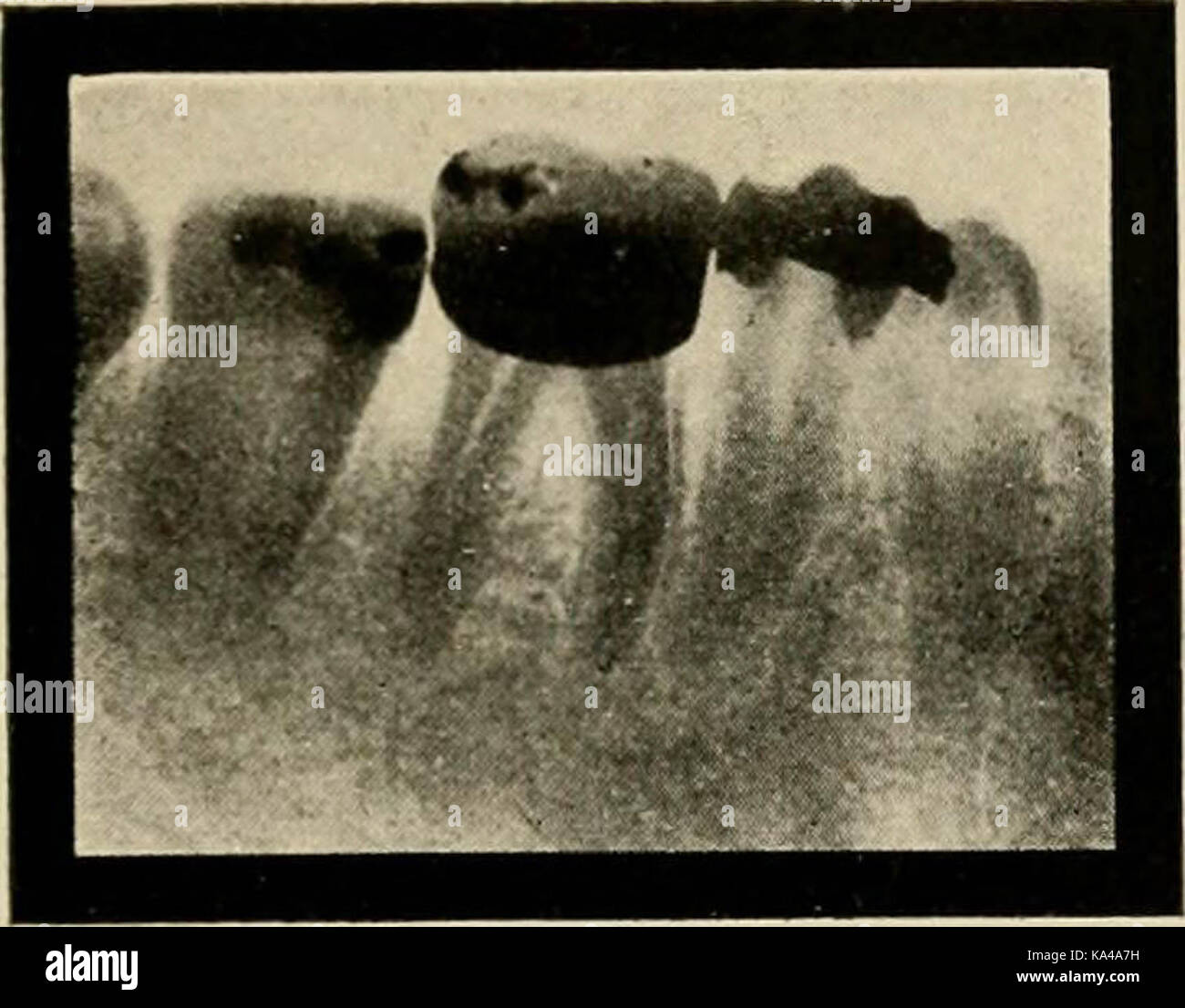 "Elementary and dental radiography / by Howard Riley Raper" (1918 Stock ...