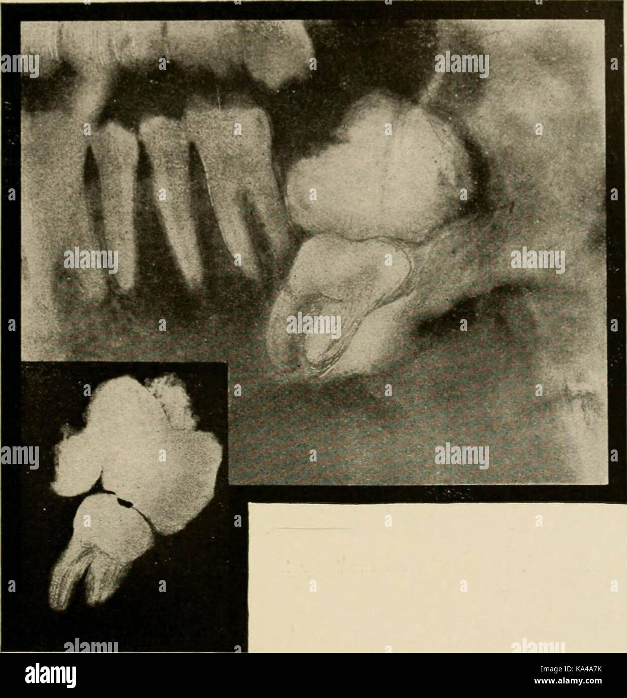 "Elementary and dental radiography / by Howard Riley Raper" (1918 Stock ...