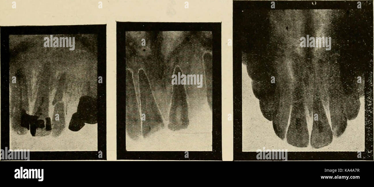 "Elementary and dental radiography / by Howard Riley Raper" (1918 Stock ...