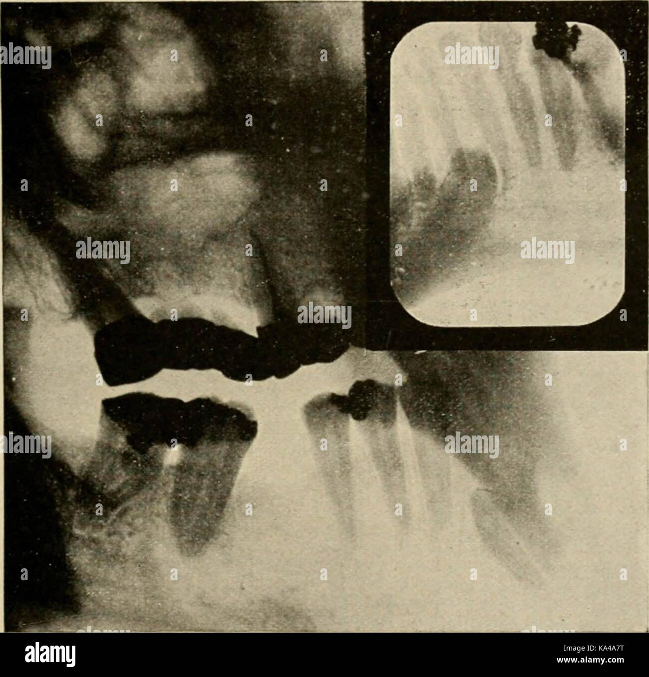 "Elementary and dental radiography / by Howard Riley Raper" (1918 Stock ...