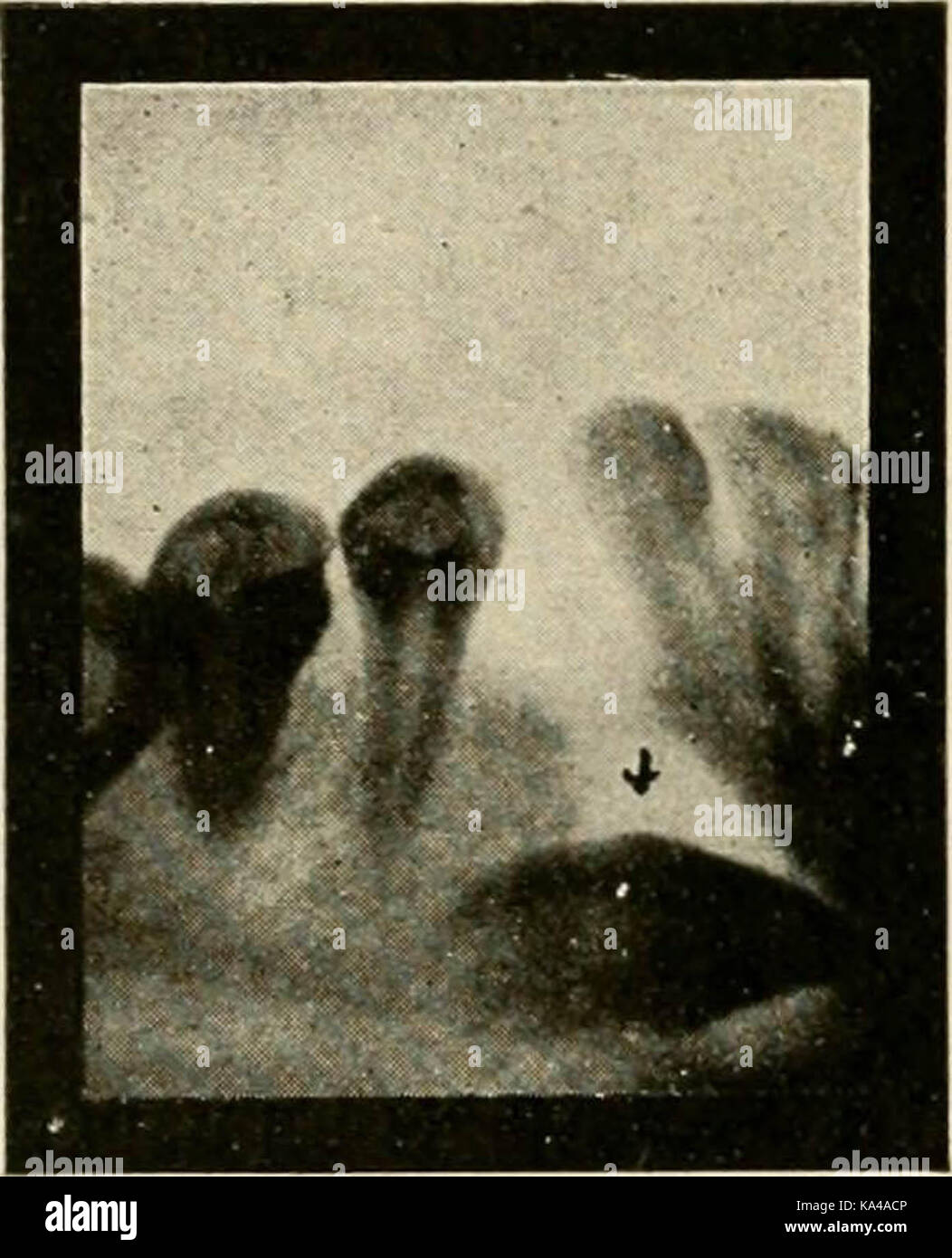 "Elementary and dental radiography / by Howard Riley Raper" (1918 Stock ...