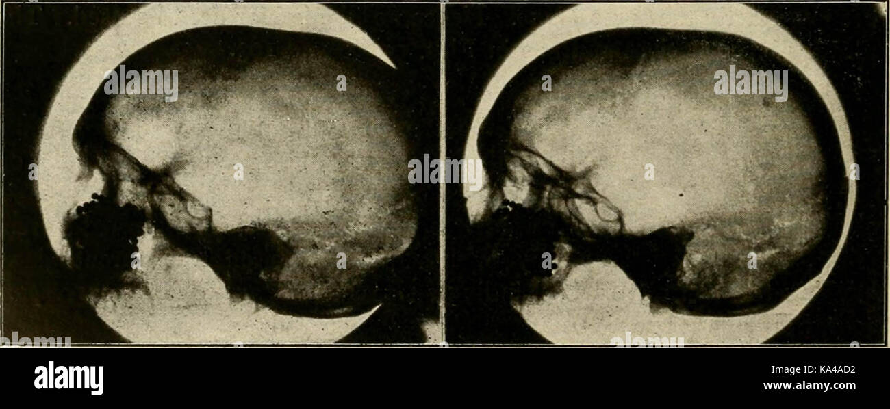 "Elementary and dental radiography / by Howard Riley Raper" (1918 Stock ...