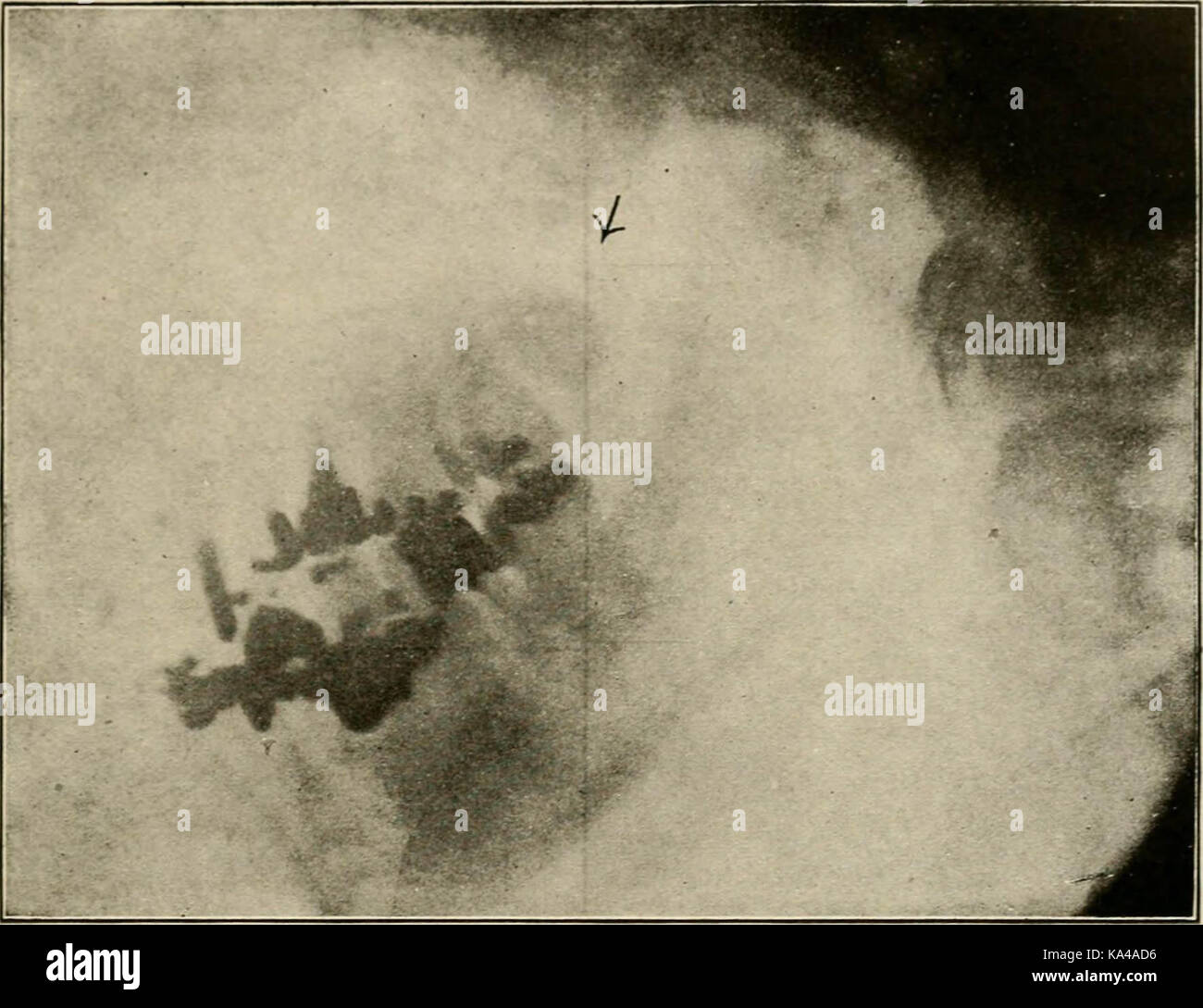 "Elementary and dental radiography / by Howard Riley Raper" (1918 Stock ...