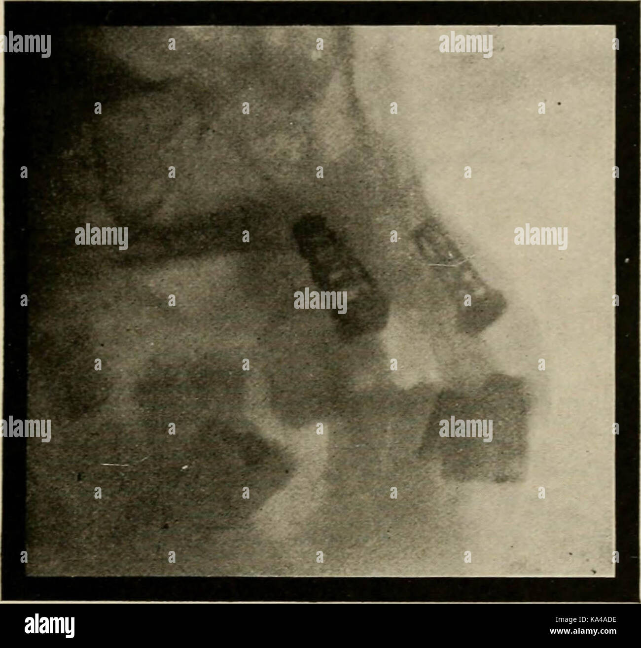 "Elementary and dental radiography / by Howard Riley Raper" (1918 Stock ...