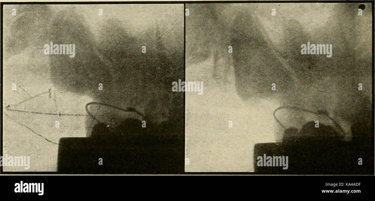 "Elementary and dental radiography / by Howard Riley Raper" (1918 Stock ...