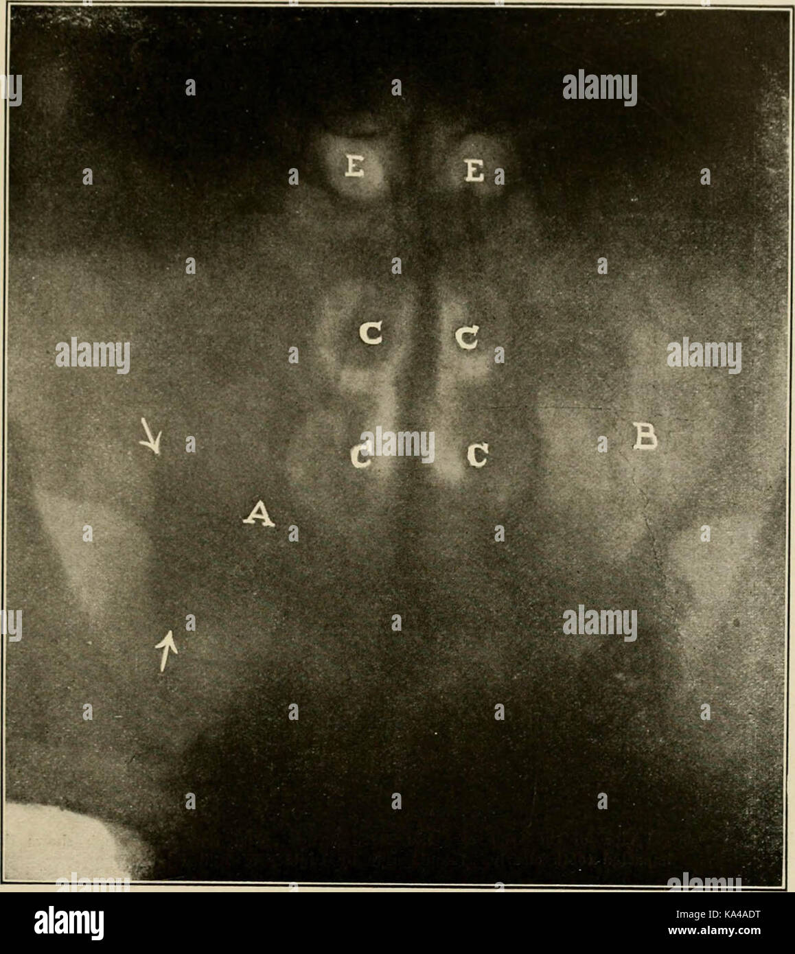 "Elementary and dental radiography / by Howard Riley Raper" (1918 Stock ...