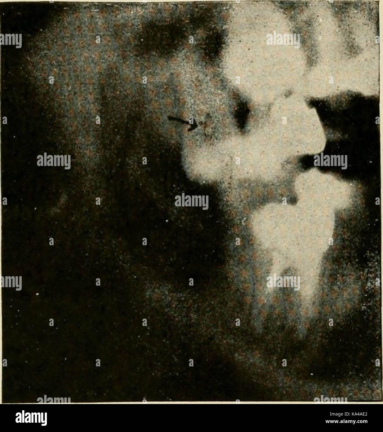 "Elementary and dental radiography / by Howard Riley Raper" (1918 Stock ...