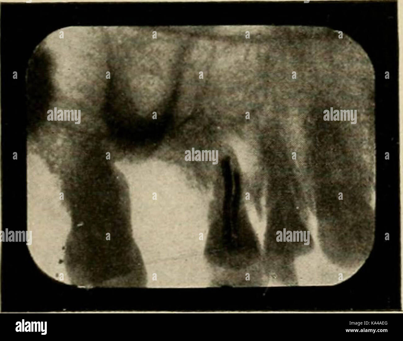 "Elementary and dental radiography / by Howard Riley Raper" (1918 Stock ...