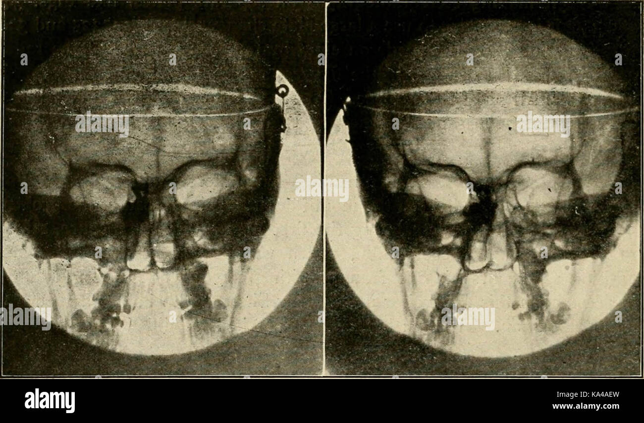 "Elementary and dental radiography / by Howard Riley Raper" (1918 Stock ...