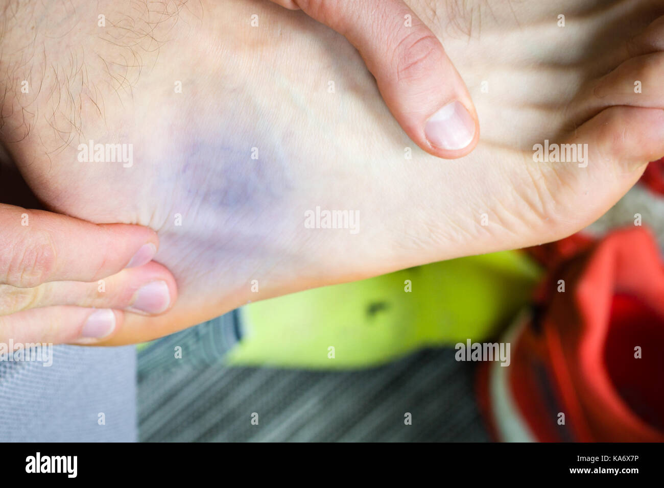 Contusion hi-res stock photography and images - Alamy