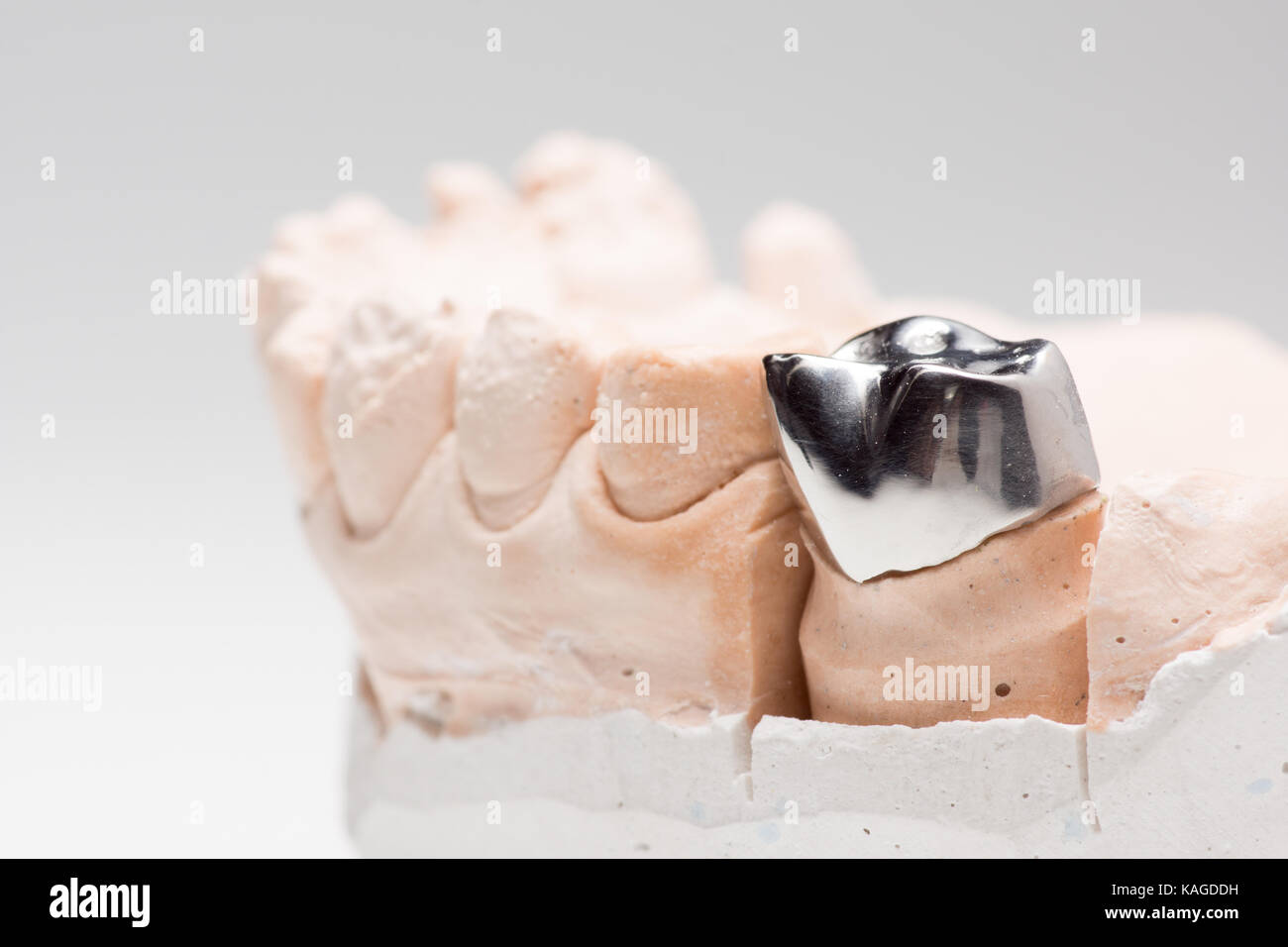 Steel artificial dental crown for dentition restoration Stock Photo - Alamy