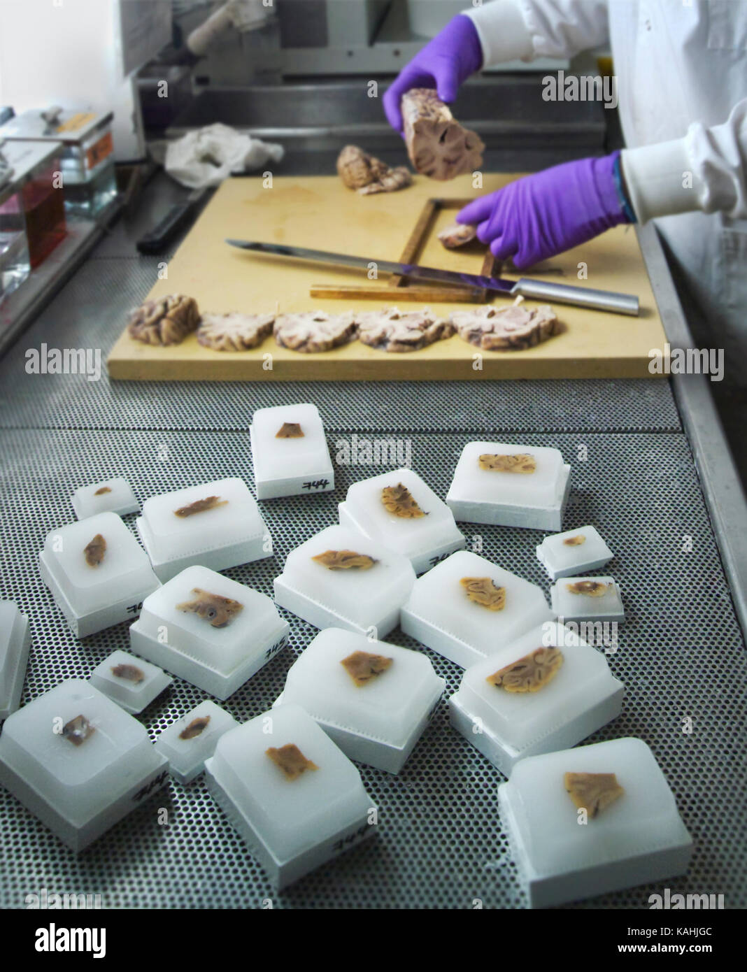 A human brain is sliced into standard 1cm slices for histological ...