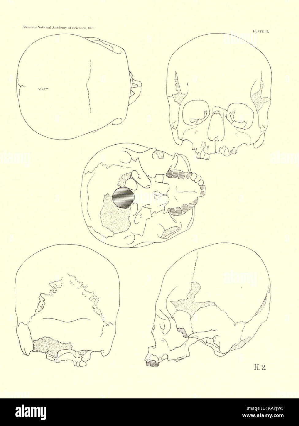 The human bones of the Hemenway collection in the United States Army ...