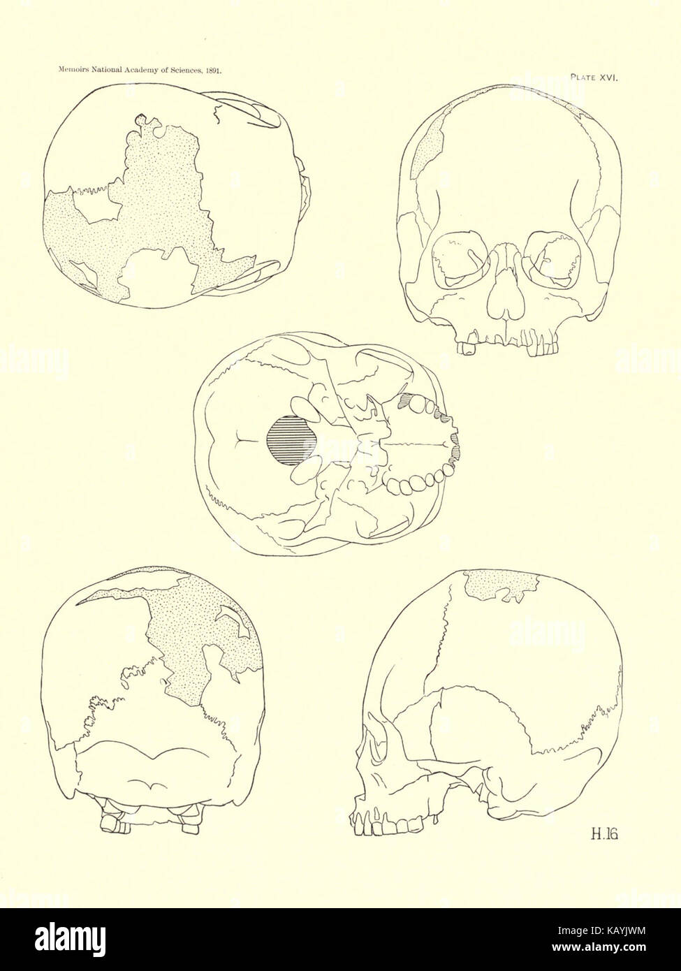 The human bones of the Hemenway collection in the United States Army ...