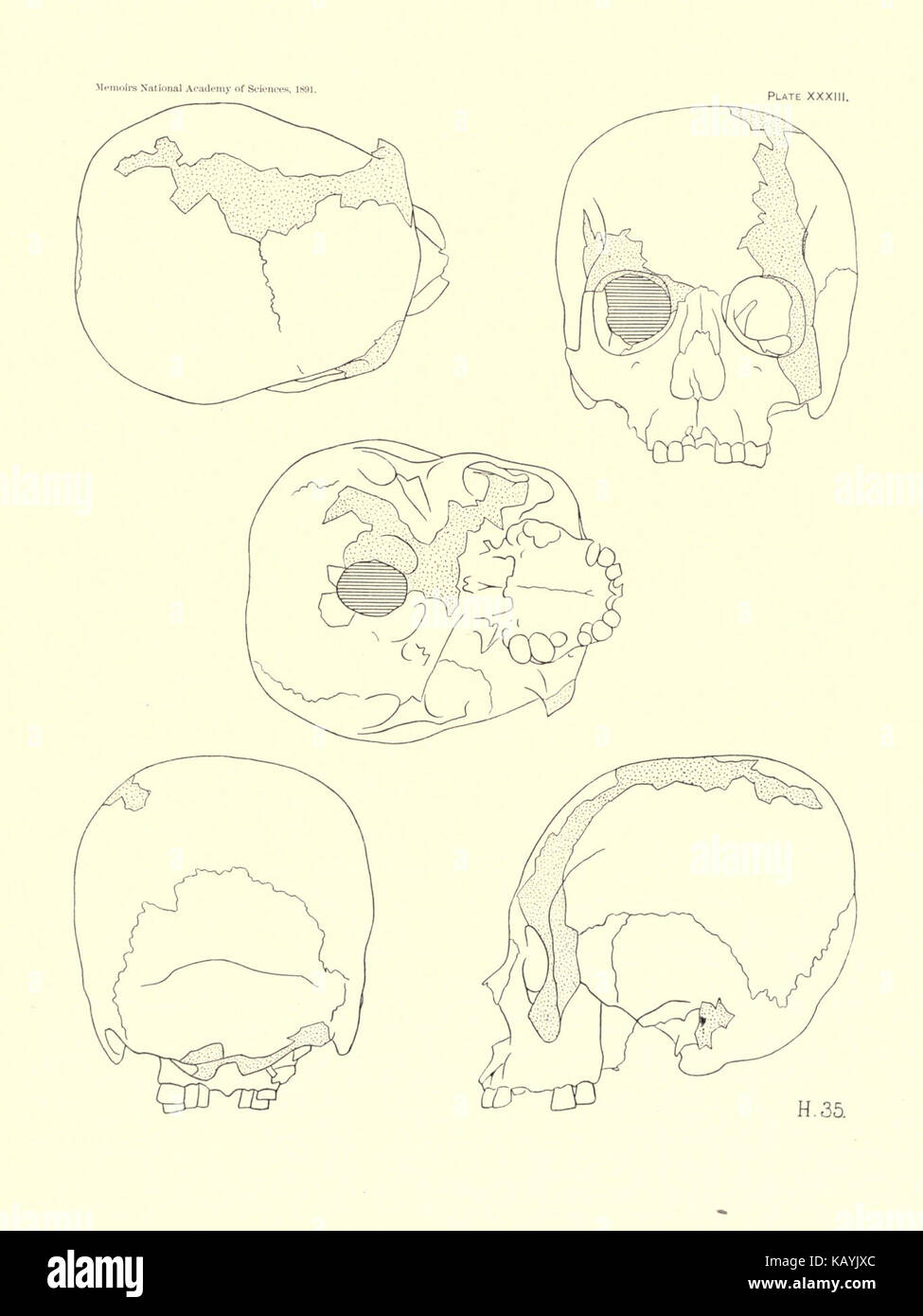 The human bones of the Hemenway collection in the United States Army ...
